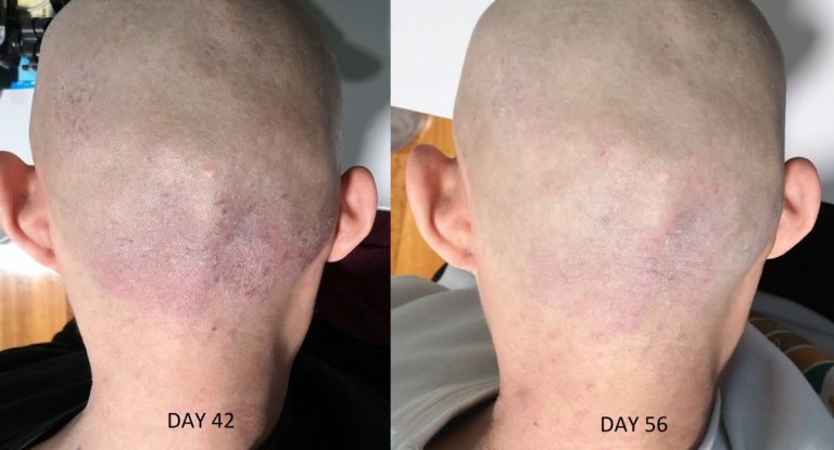 Day 56: 7 weeks NMT/8 weeks TSW - Healing TSW